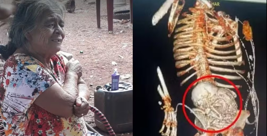 Idosa descobre feto calcificado que carregou por mais de 50 anos ...