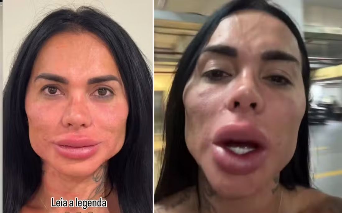 Kamila Simioni surpreende ao mostrar nova harmonização facial: 'A boca ...