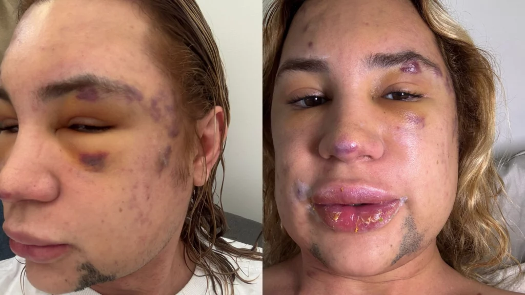 O que é 'Fox Eyes', procedimento que matou o influenciador Junior Dutra ...